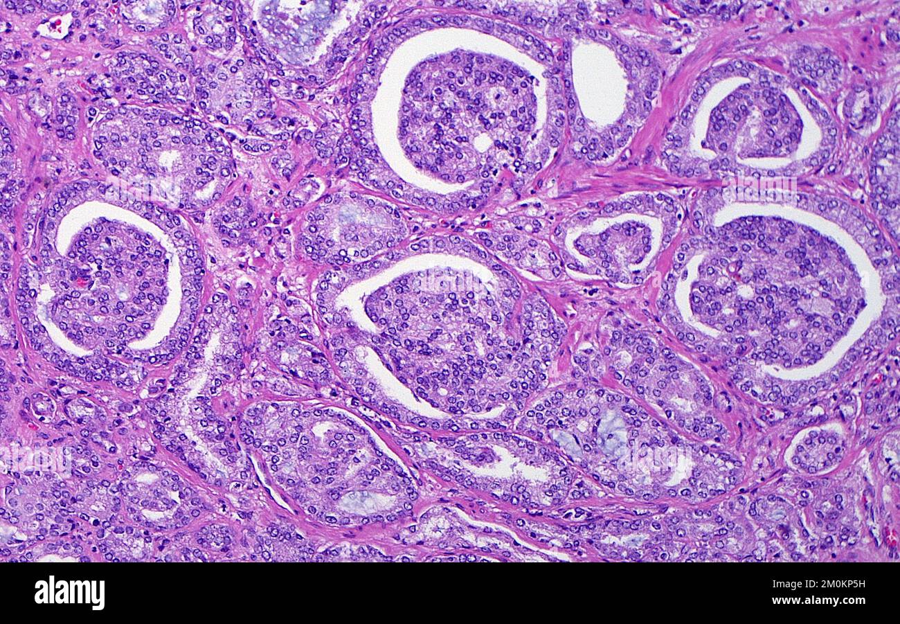 Prostate cancer, light micrograph Stock Photo - Alamy