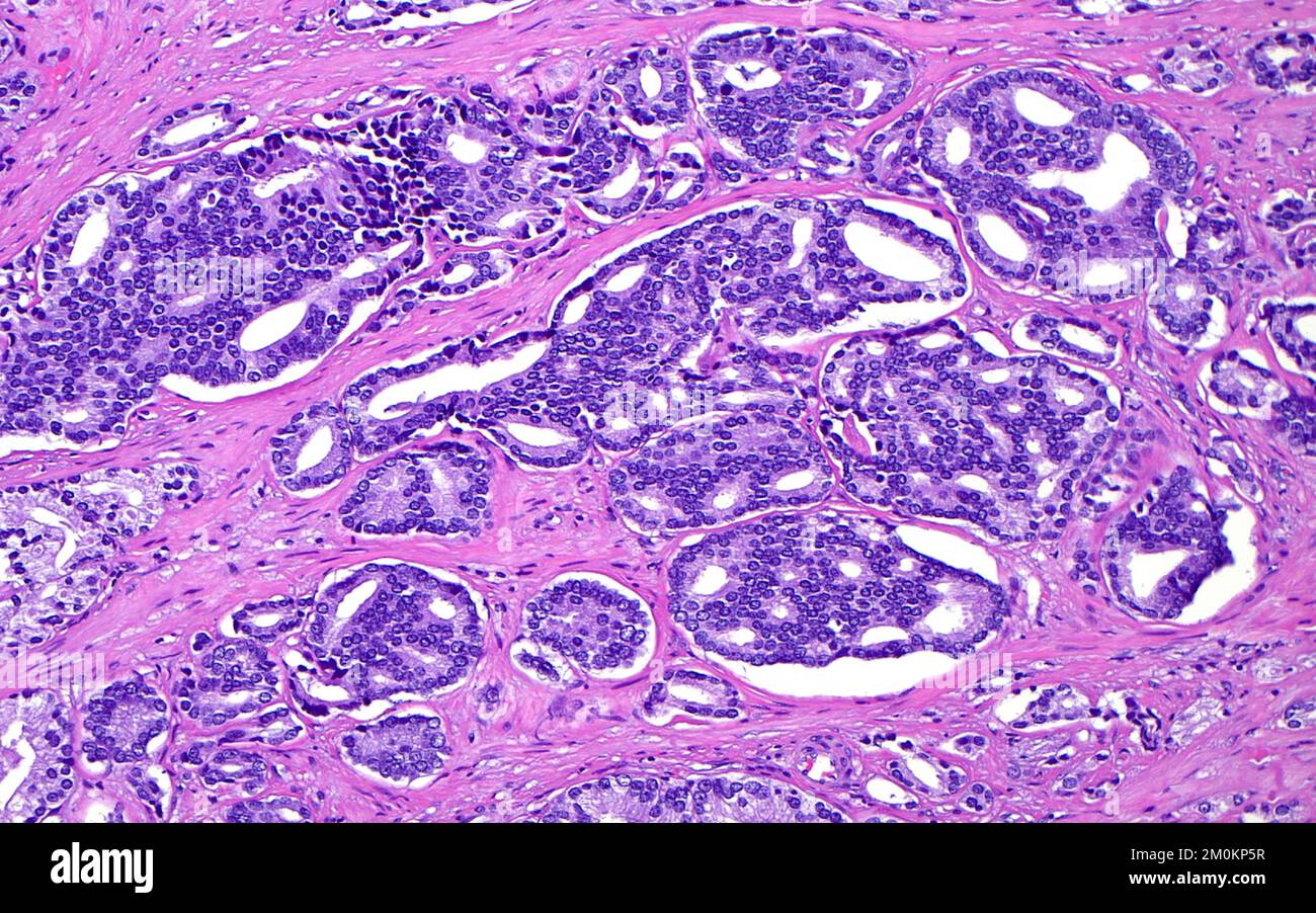 Prostate cancer, light micrograph Stock Photo - Alamy