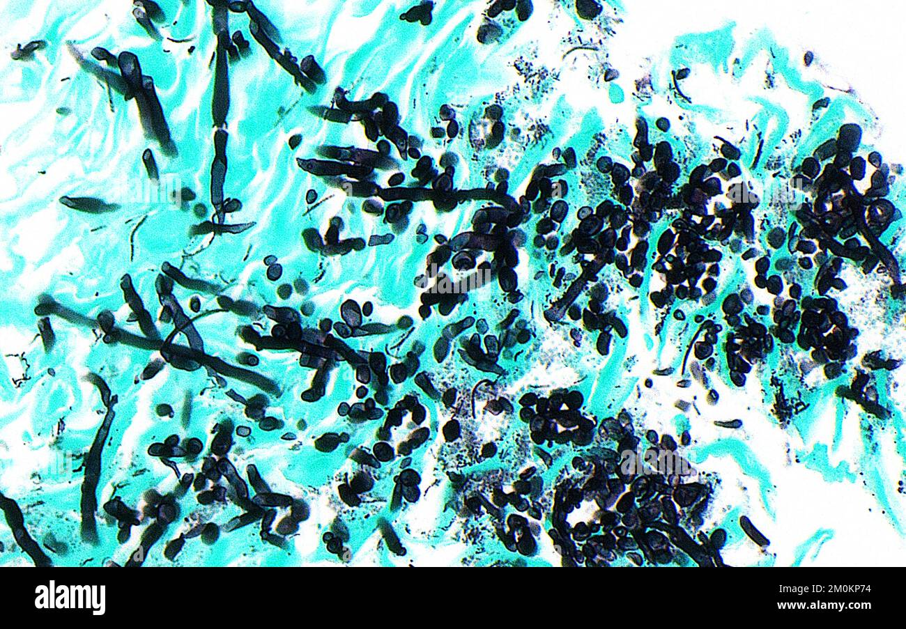 Candida fungal infection, light micrograph Stock Photo - Alamy