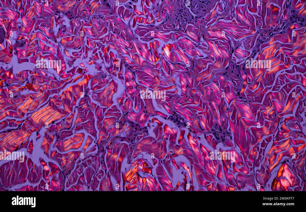 Collagen, polarised light micrograph Stock Photo - Alamy
