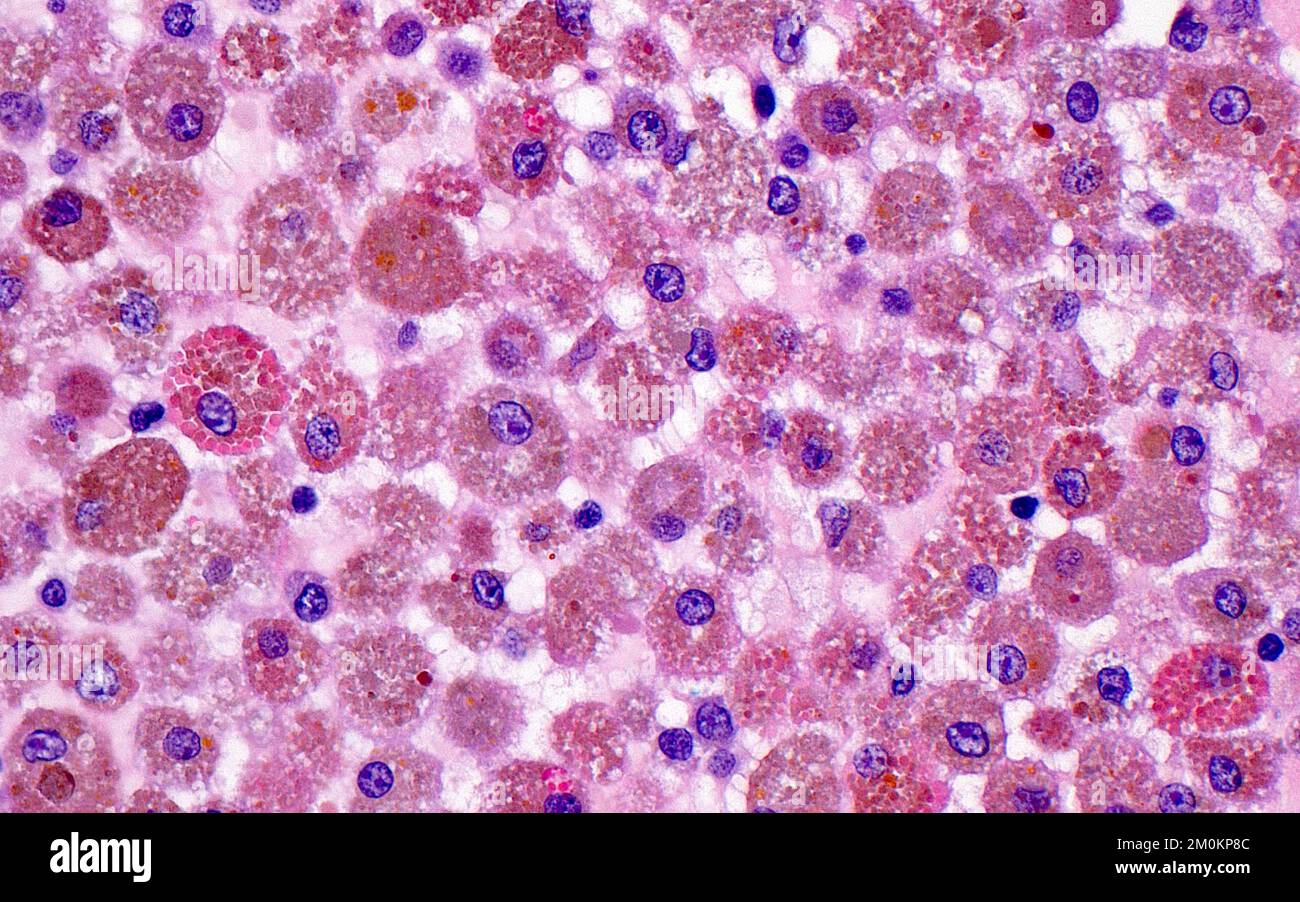 Macrophage cells ingesting hemosiderin, light micrograph Stock Photo ...