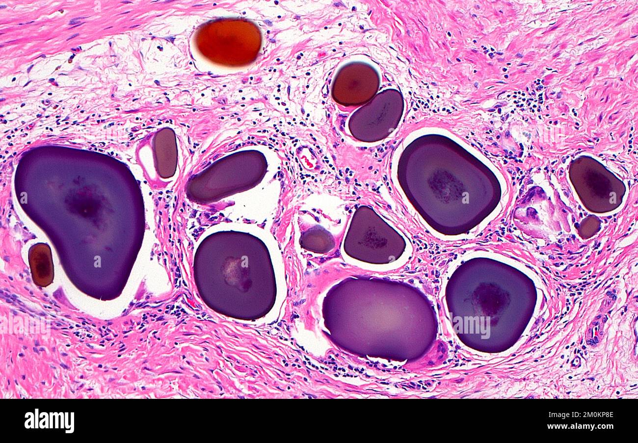 Prostate corpora amylacea, light micrograph Stock Photo - Alamy