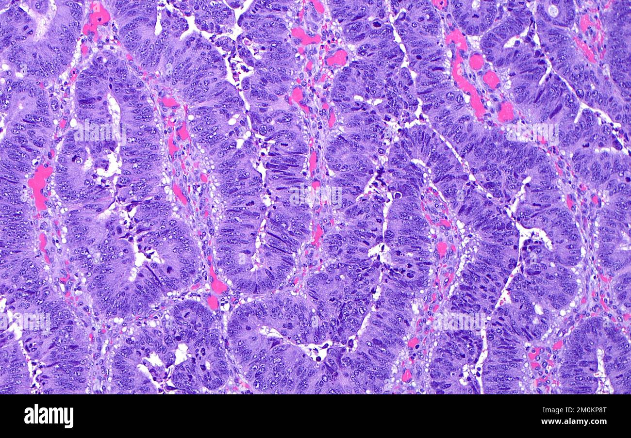 Colon cancer cells, light micrograph Stock Photo - Alamy