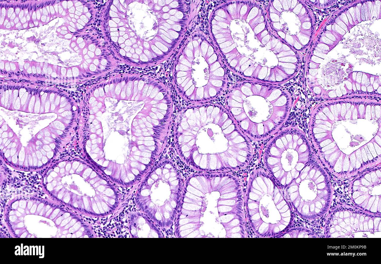 Colon hyperplastic polyp, light micrograph Stock Photo - Alamy