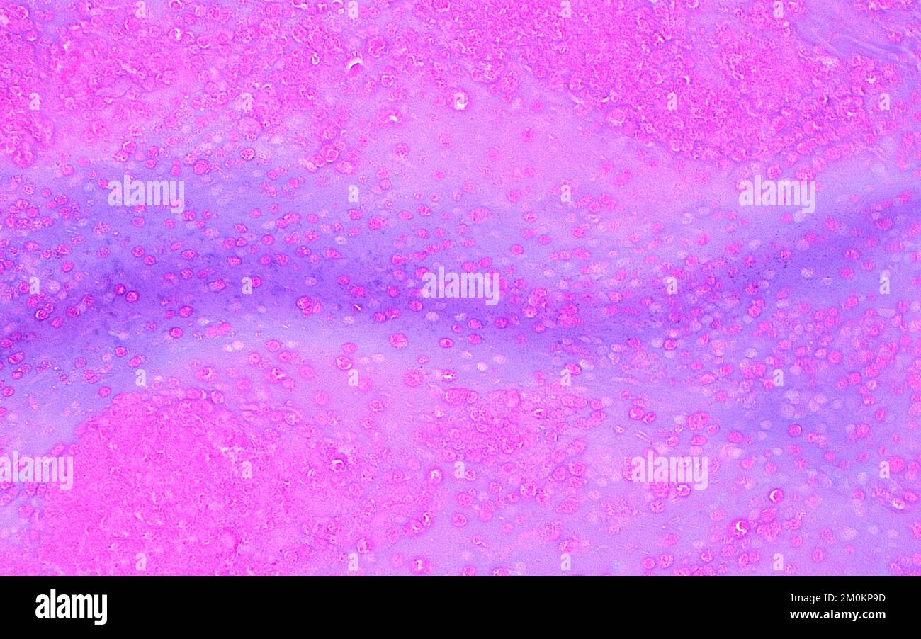 Substance in Warthin tumour, light micrograph Stock Photo - Alamy