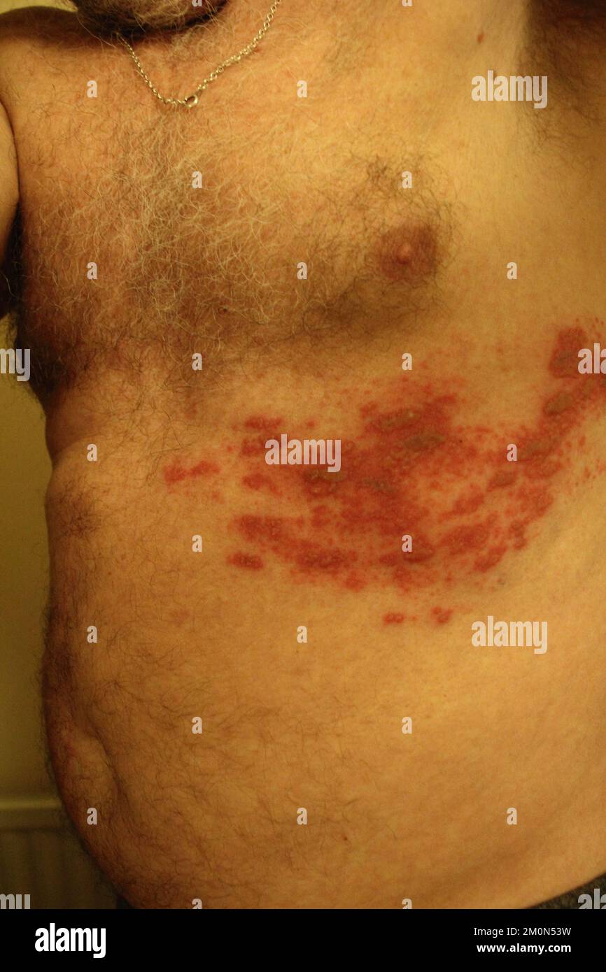 The painful red blister rash of Shingles,Herpes Zoster Stock Photo - Alamy