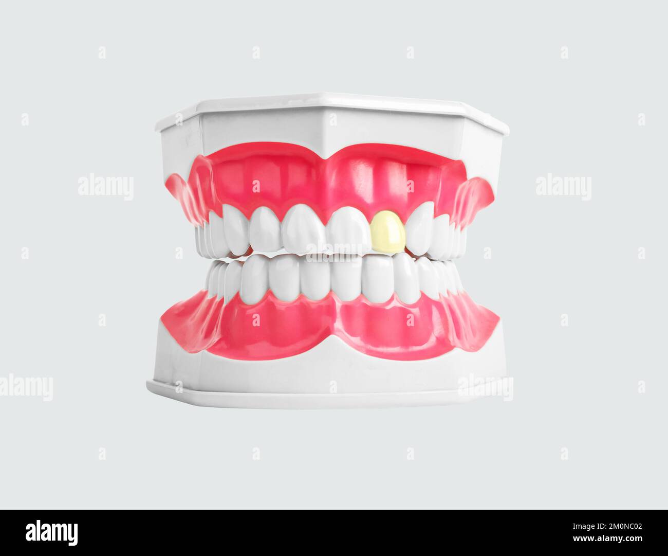 Jaw with white healthy teeth and one unhealthy tooth with caries ...