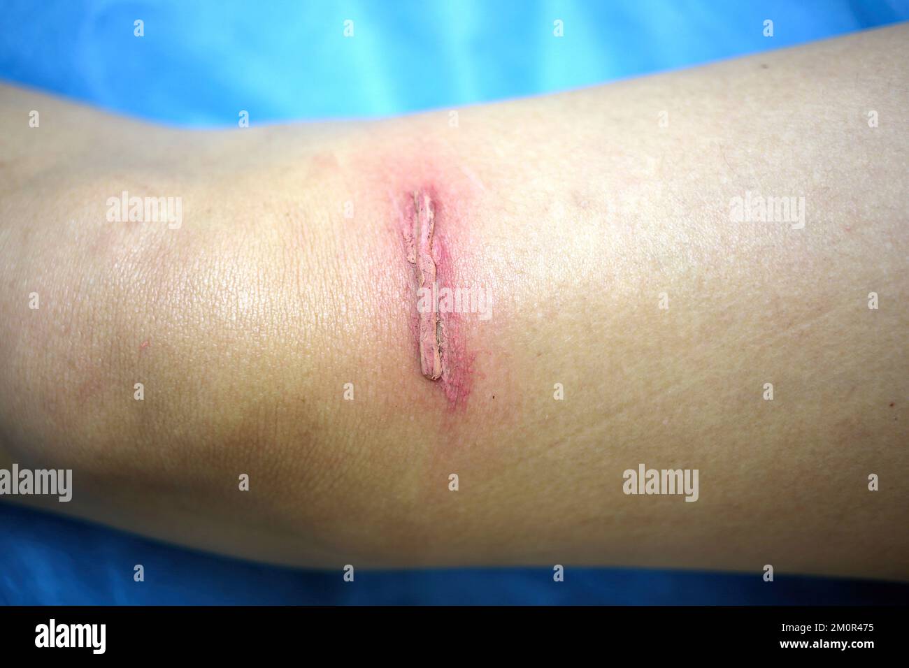 Colloidal scar hi-res stock photography and images - Alamy