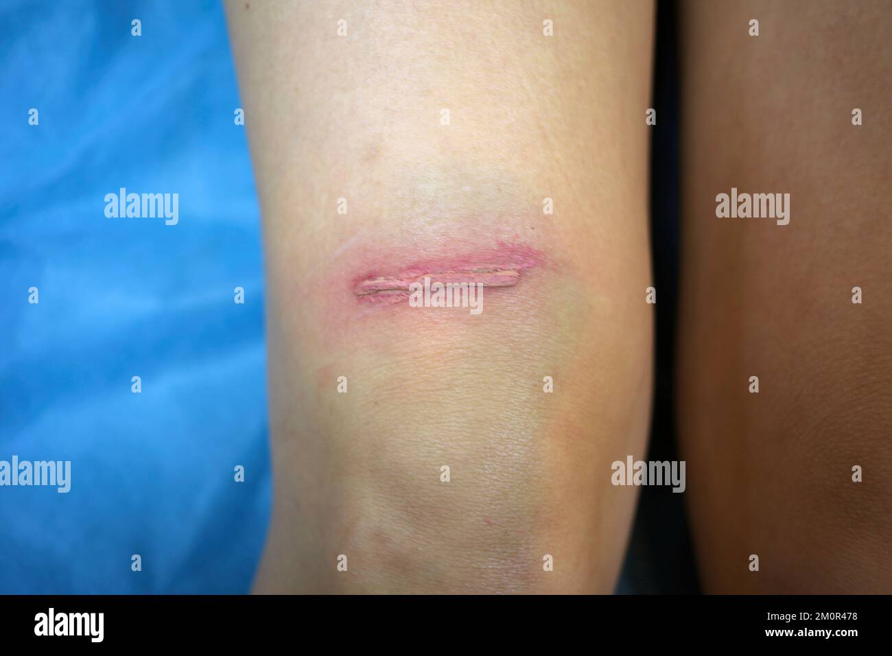 Colloidal scar hi-res stock photography and images - Alamy