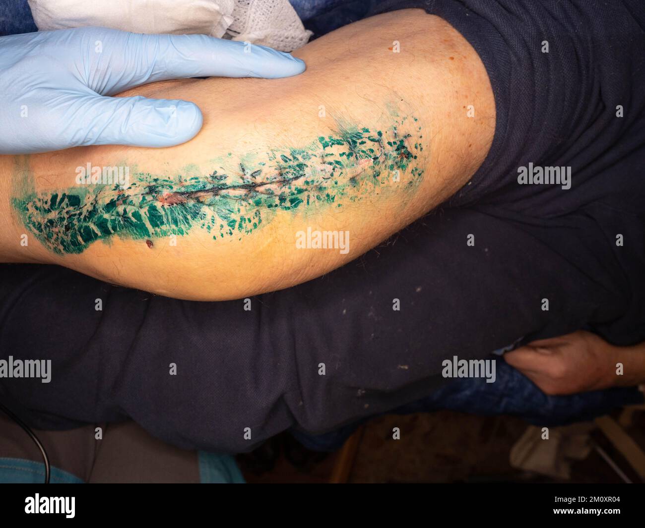 Knee joint replacement. Interview between doctor and patient regarding ...