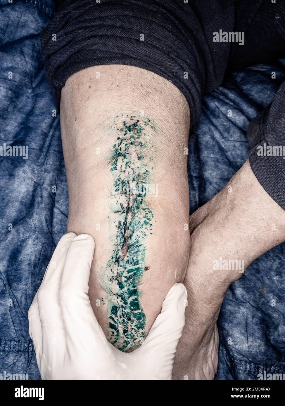 Total endoprosthesis of the knee joint and meniscus. Medic check male ...