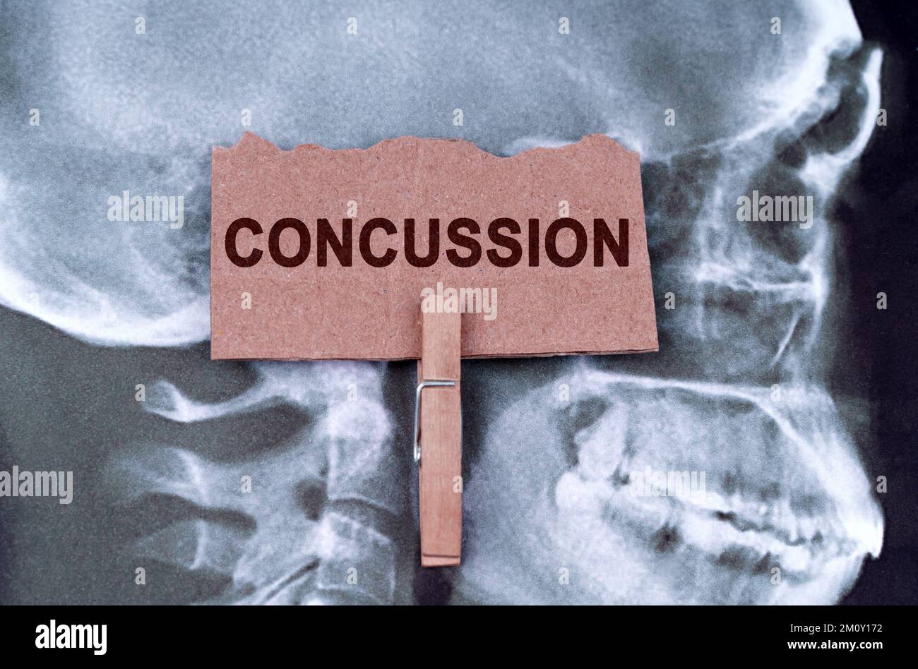 Medicine concept. Against the background of an X-ray of the skull, a ...