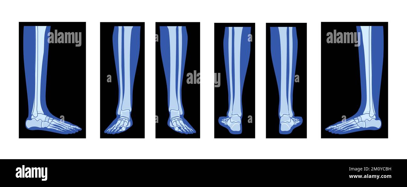 Set of X-Ray Foot Legs Skeleton Human body, Bones adult people roentgen ...