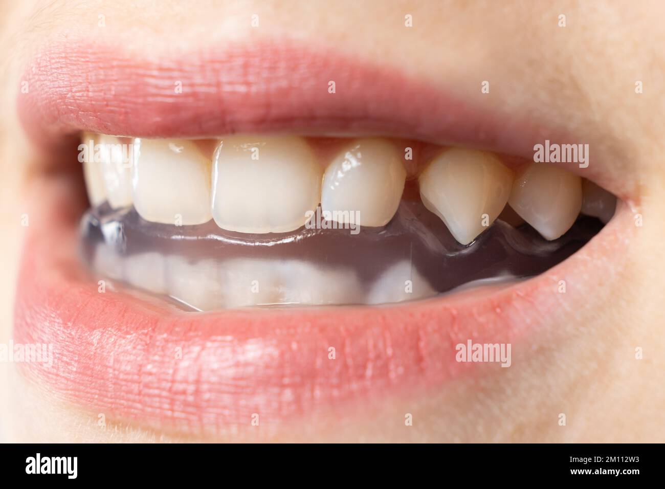 Dental mouthguard, splint in the mouth for the treatment of dysfunction ...