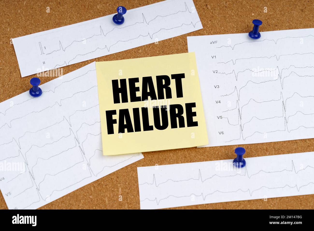 Medicine and health concept. Attached to the board are cardiogram ...