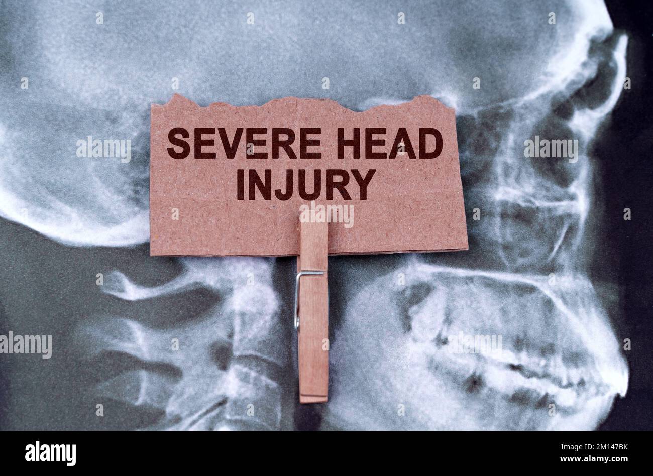 Medicine concept. Against the background of an X-ray of the skull, a plate with the inscription ...