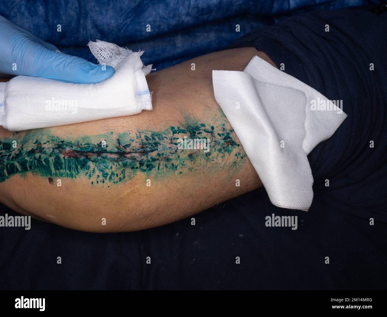 Patient with arthritis after total knee replacement. The doctor checks ...