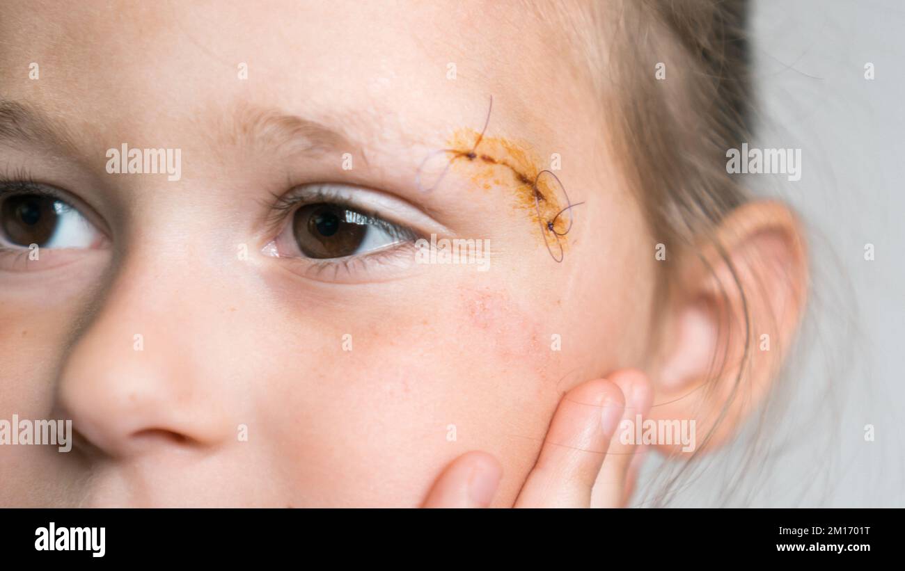 Close up sad, drear cropped cute girl face with stitches on scratch of ...