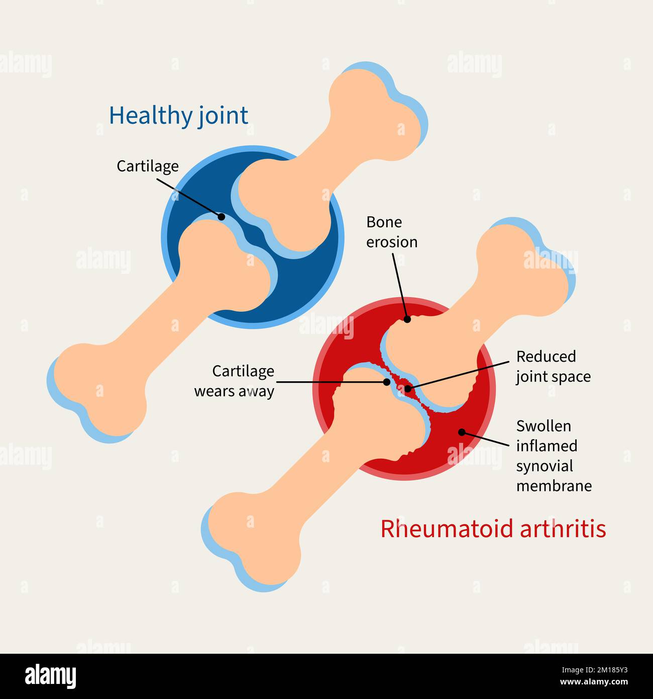 Rheumatoid arthritis illustration Stock Vector Image & Art - Alamy