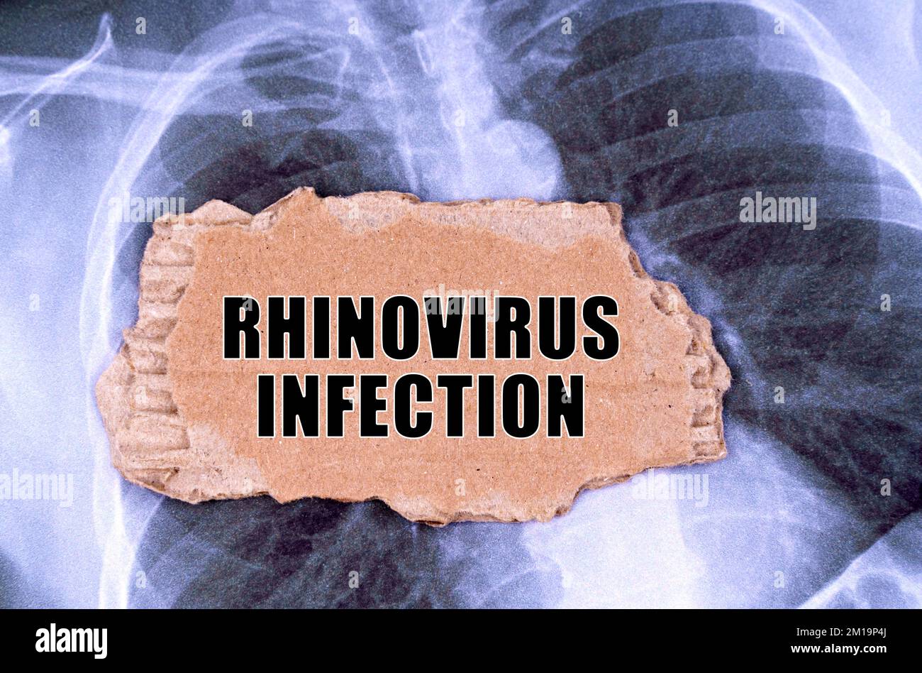 Rhinovirus Infection