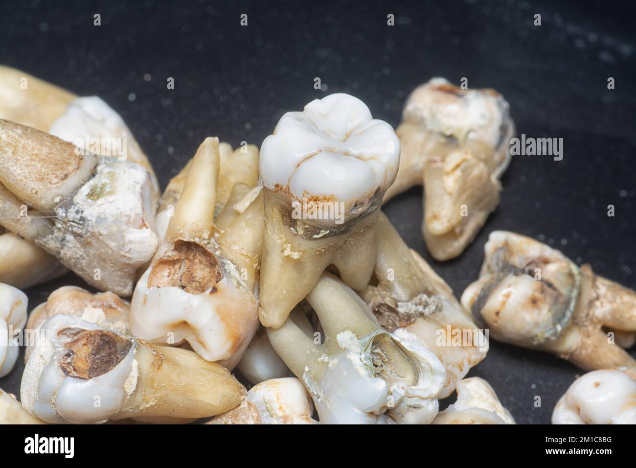 the bundle of unwanted extracted decay human teeth Stock Photo - Alamy
