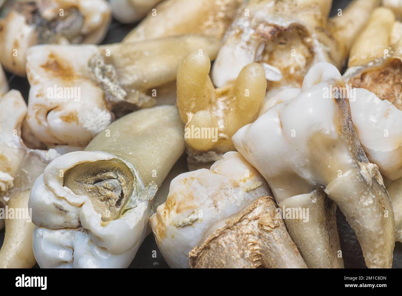 the bundle of unwanted extracted decay human teeth Stock Photo - Alamy