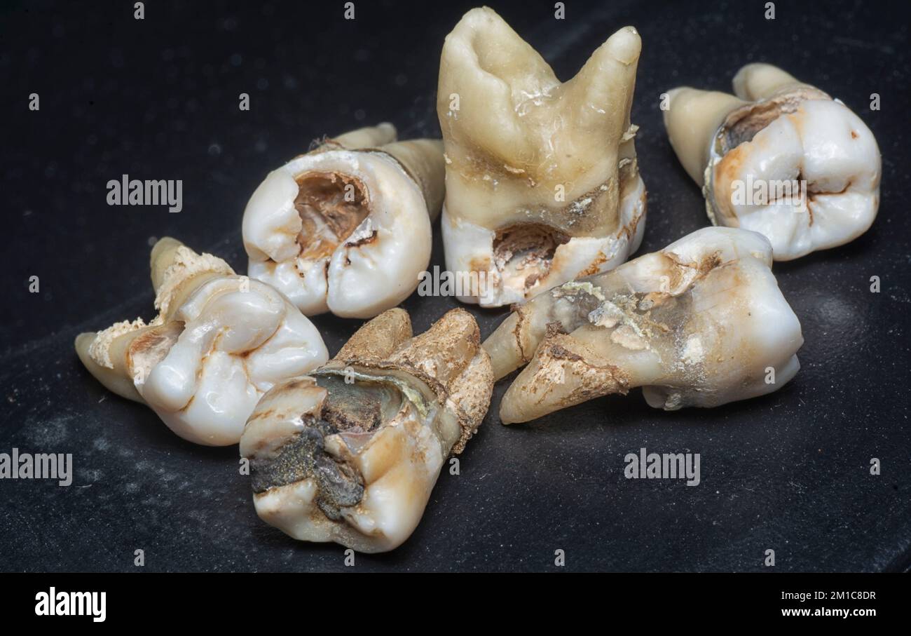 the bundle of unwanted extracted decay human teeth Stock Photo - Alamy