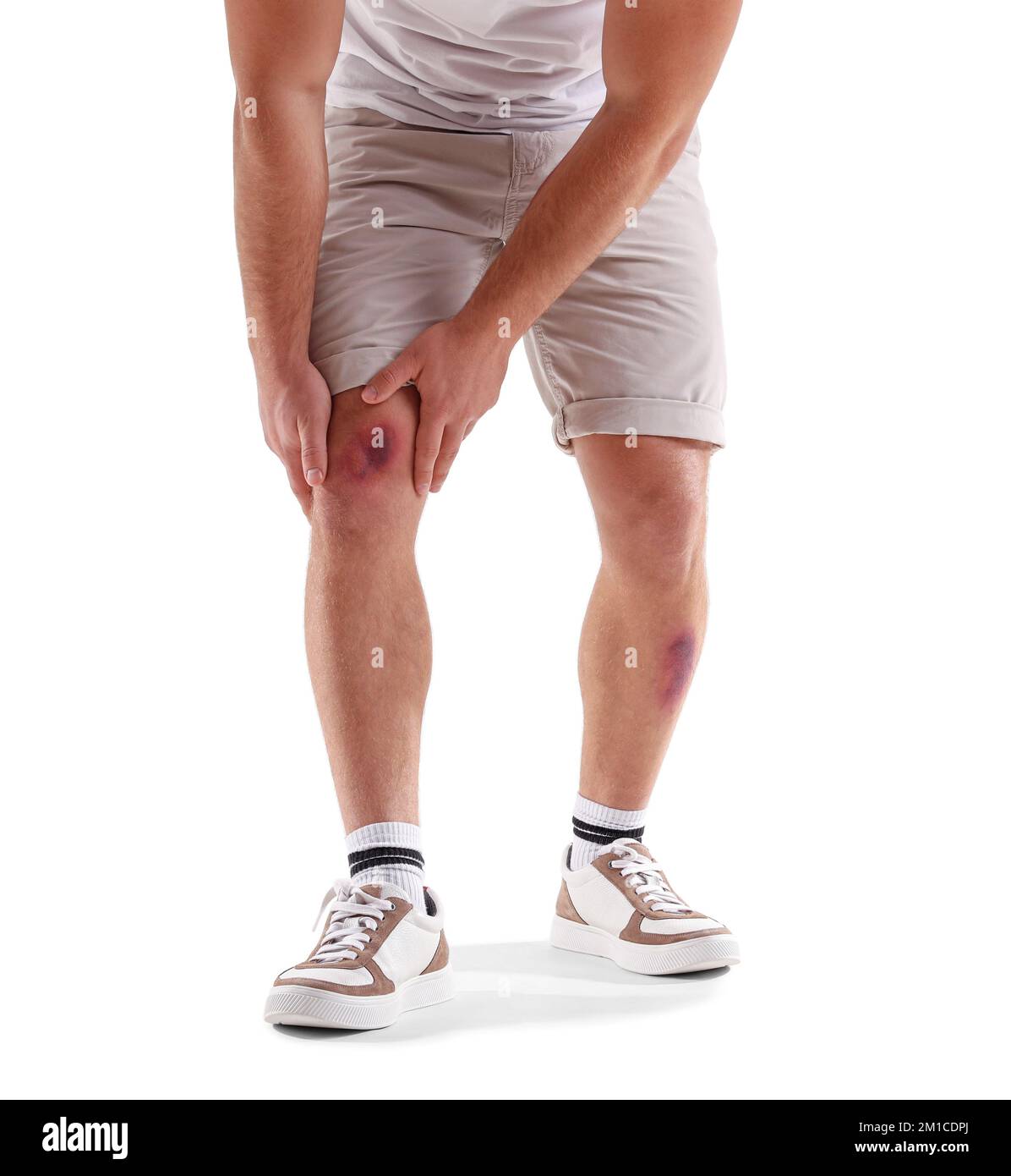 Man with bruises on legs against white background Stock Photo - Alamy