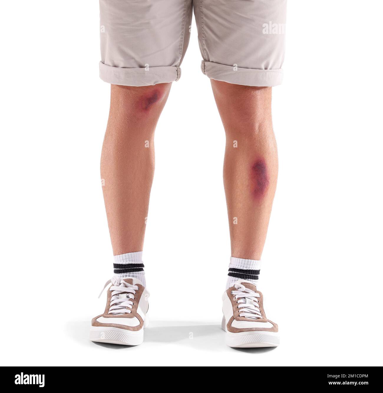 Man with bruises on legs against white background Stock Photo - Alamy