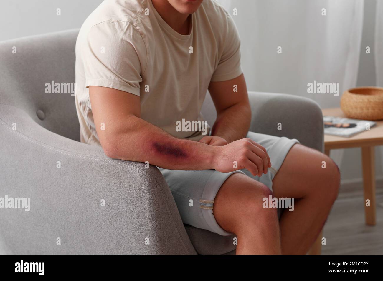 Bruised arm hi-res stock photography and images - Alamy