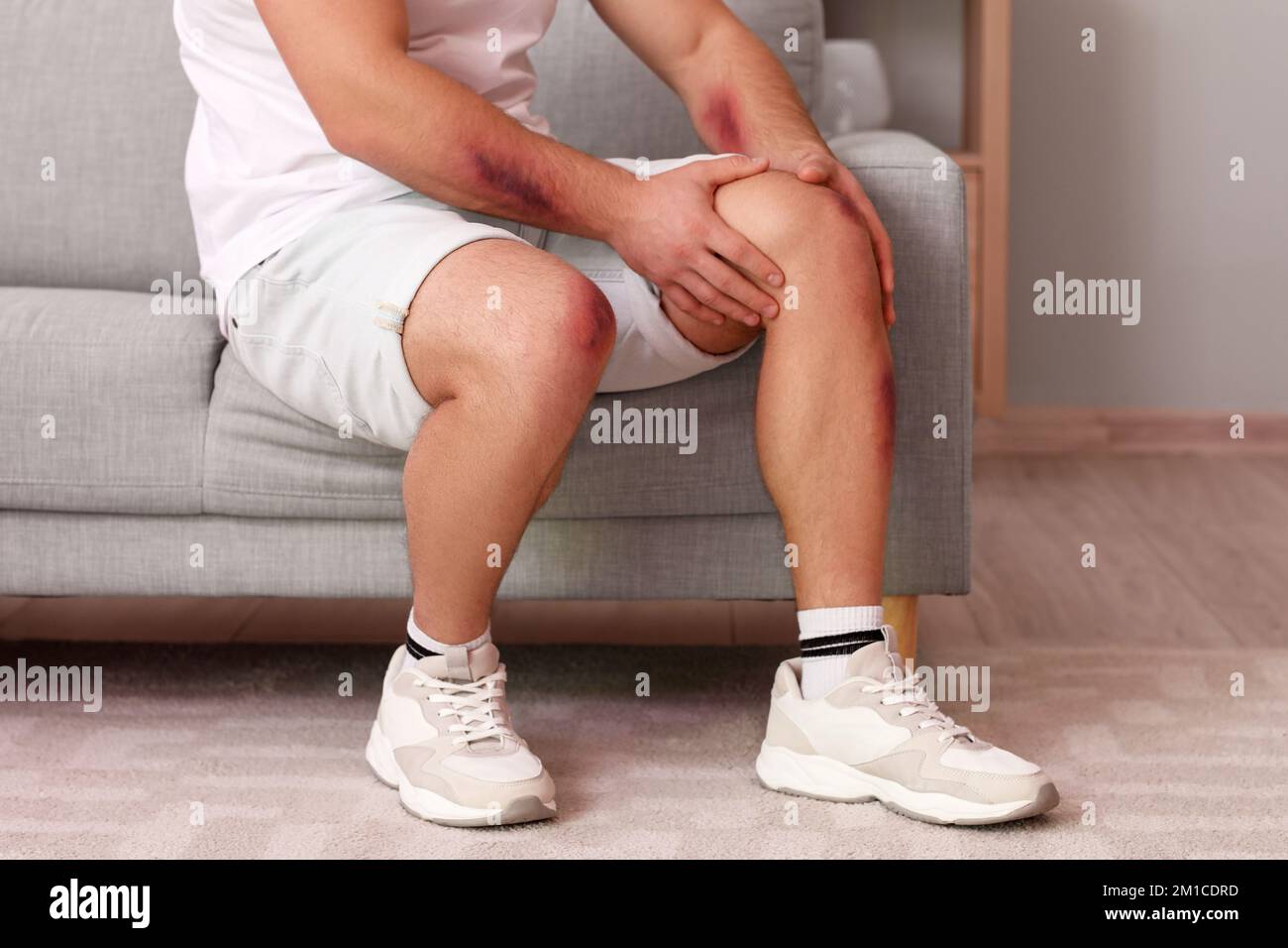 Man with bruises on his body at home Stock Photo - Alamy