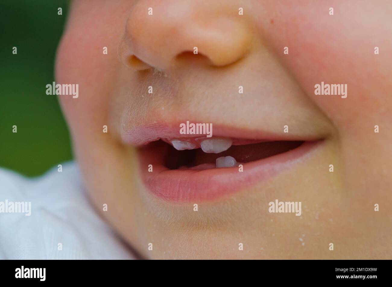 The first teeths coming through in the mouth of a one year old child ...