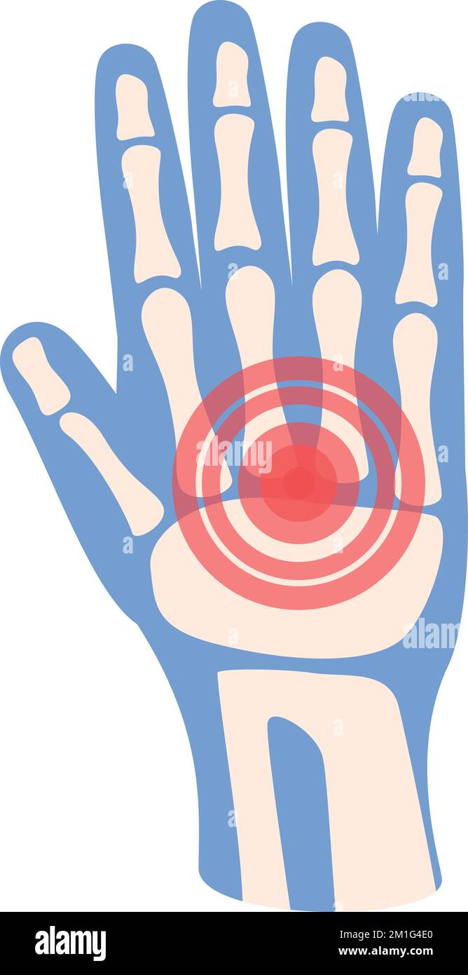 Hand pain icon cartoon vector. Medical treatment. Arthritis joint Stock ...