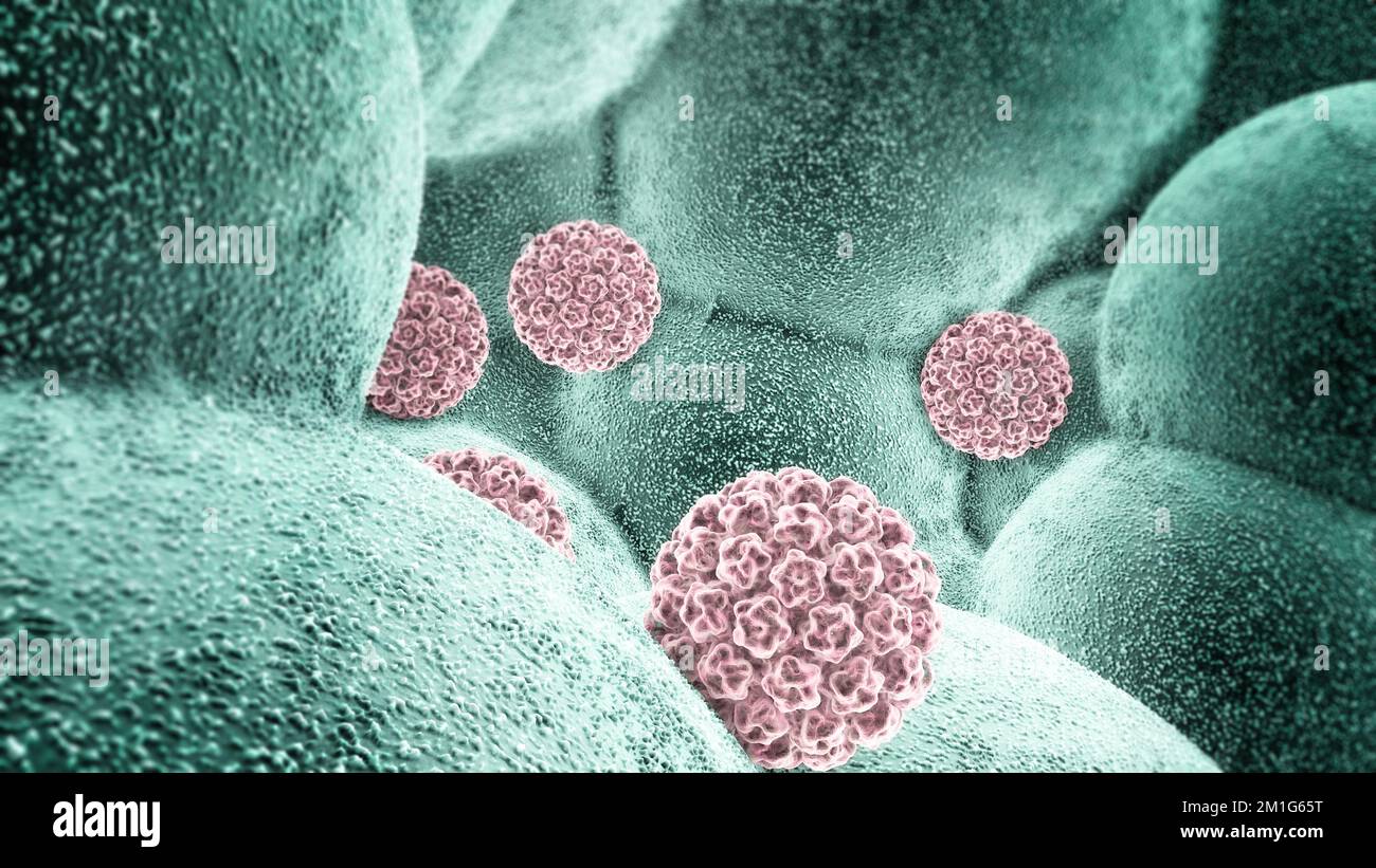Human papillomavirus infection. Virus. HPV is the most common sexually ...