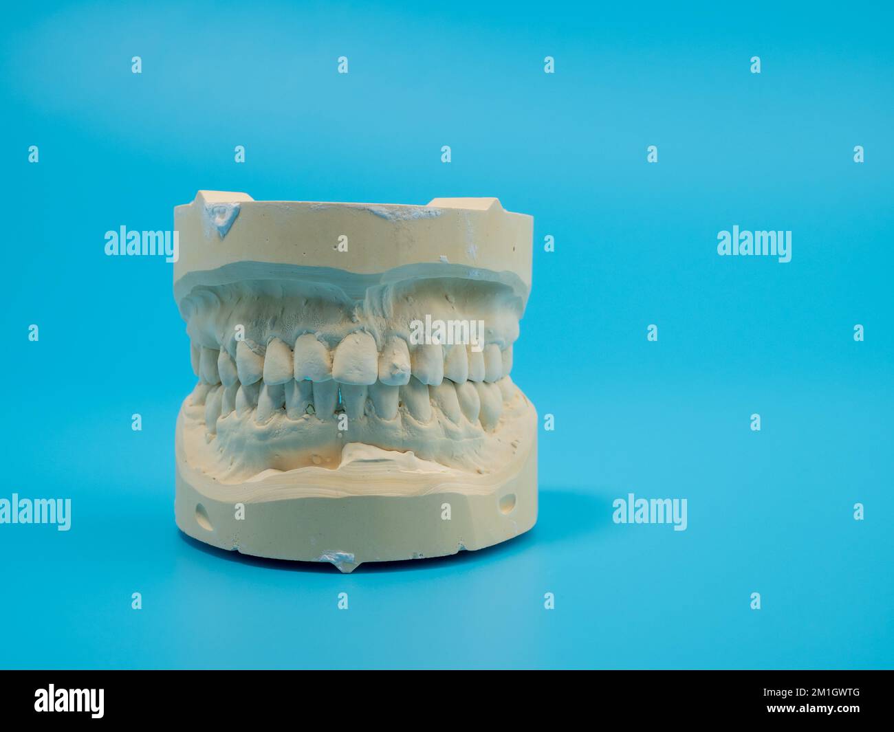 Dental casts on a blue background. Plaster model of teeth. Close-up ...