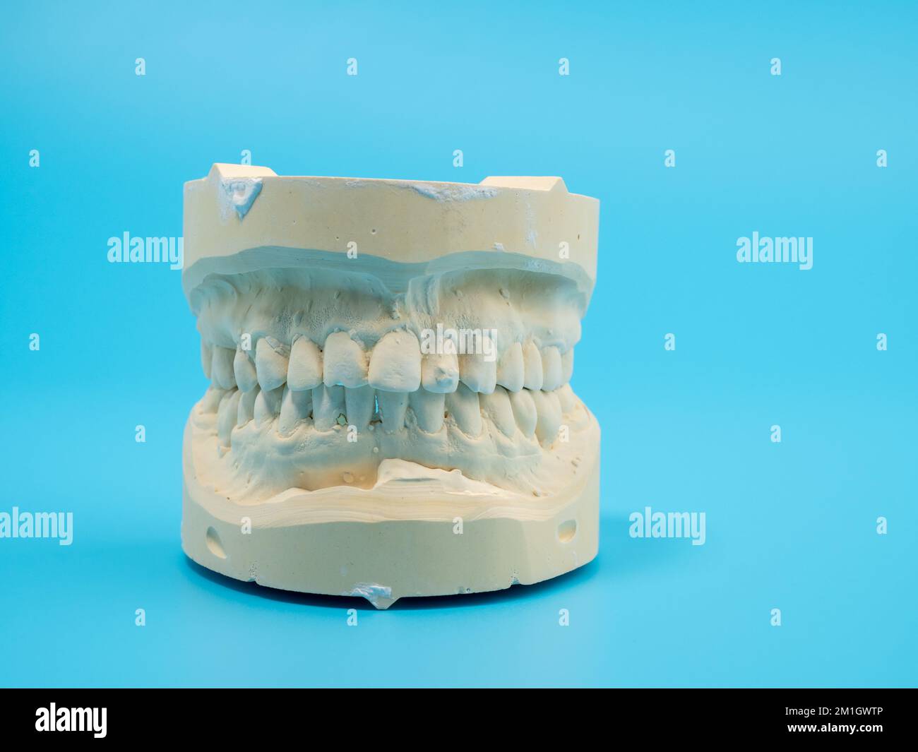 Dental casts on a blue background. Plaster model of teeth. Close-up ...
