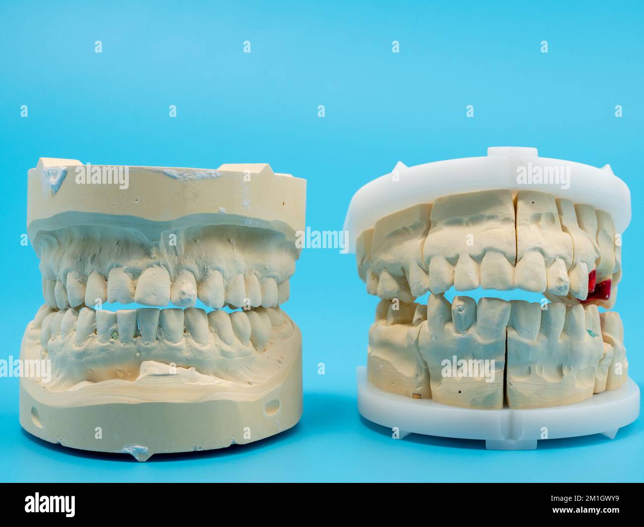 Dental casts on a blue background. Plaster model of teeth. Close-up ...