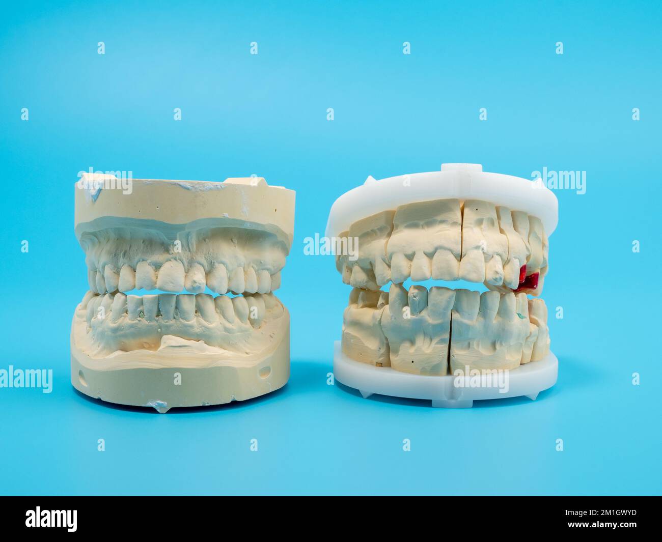 Dental casts on a blue background. Plaster model of teeth. Close-up ...