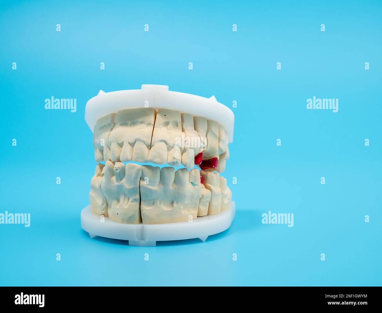 Dental casts on a blue background. Plaster model of teeth. Close-up ...