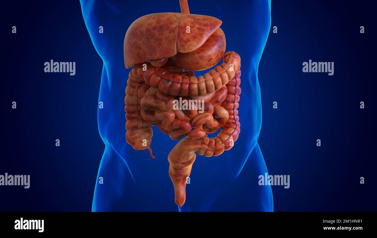 Human damaged digestive system for medical concept 3D illustration ...