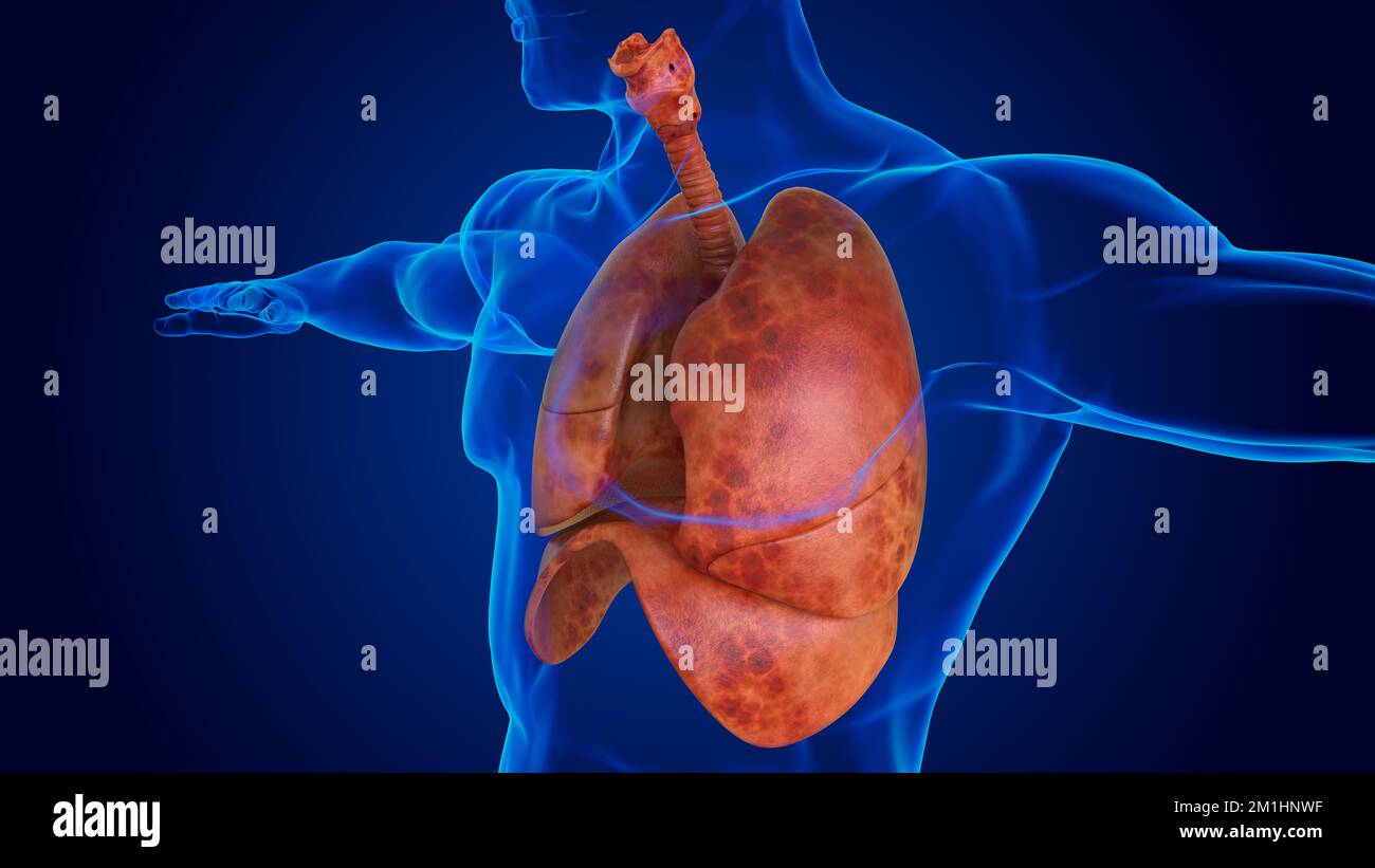 human damage lungs anatomy for medical concept 3D illustration Stock ...
