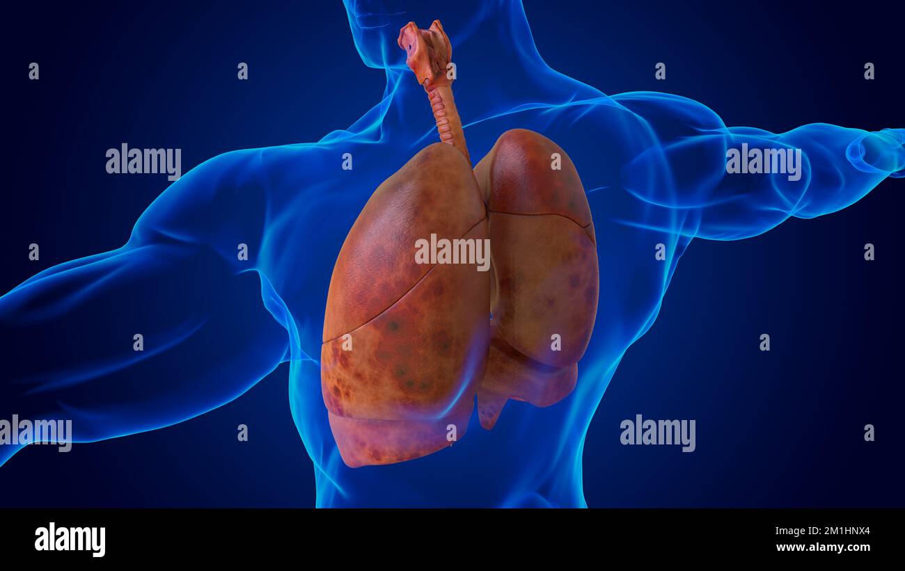 human damage lungs anatomy for medical concept 3D illustration Stock ...