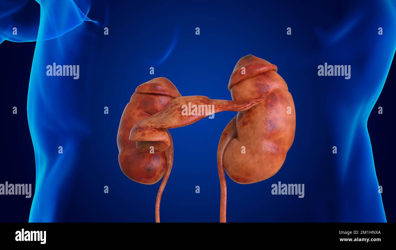 human damaged kidney anatomy for medical concept 3D illustration Stock ...