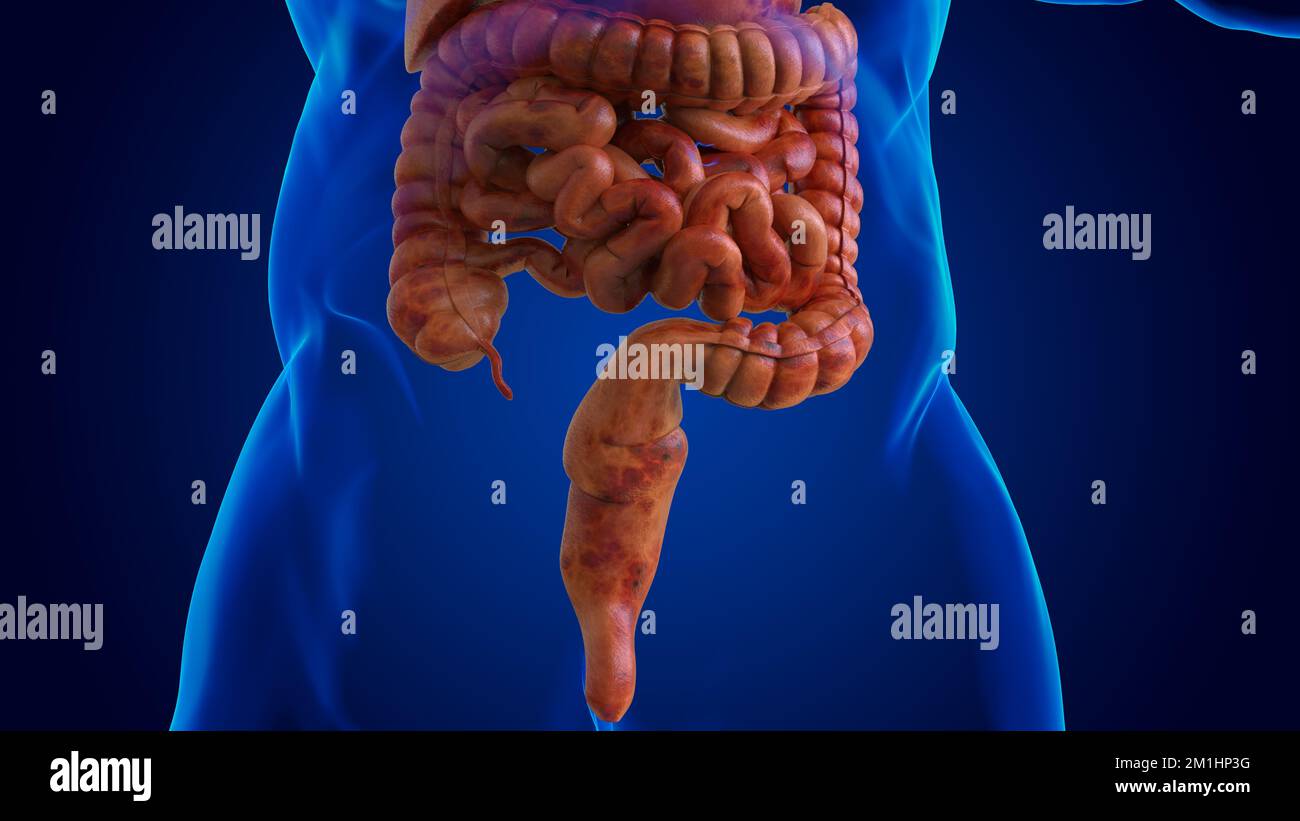 Human damaged digestive system for medical concept 3D illustration ... Human damaged digestive system for medical concept 3D illustration ...
