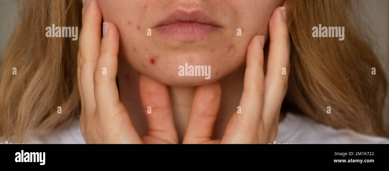Unrecognizable woman showing her acne on face. Close-up acne on woman's ...