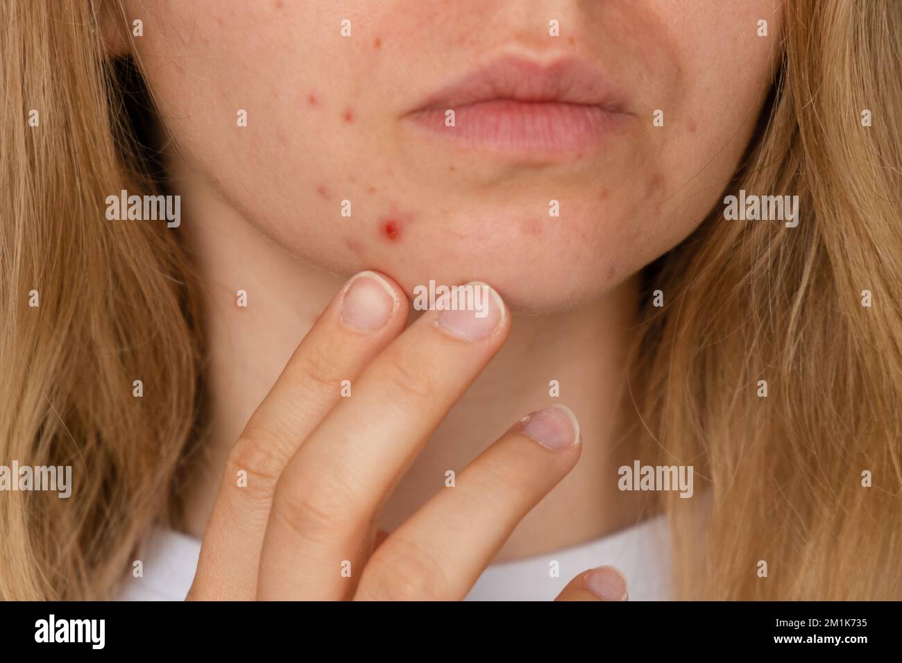 Unrecognizable woman showing her acne on face. Close-up acne on woman's ...