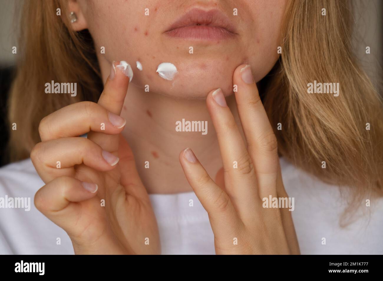 Unrecognizable woman applies makeup, cream serum cure for acne on face ...