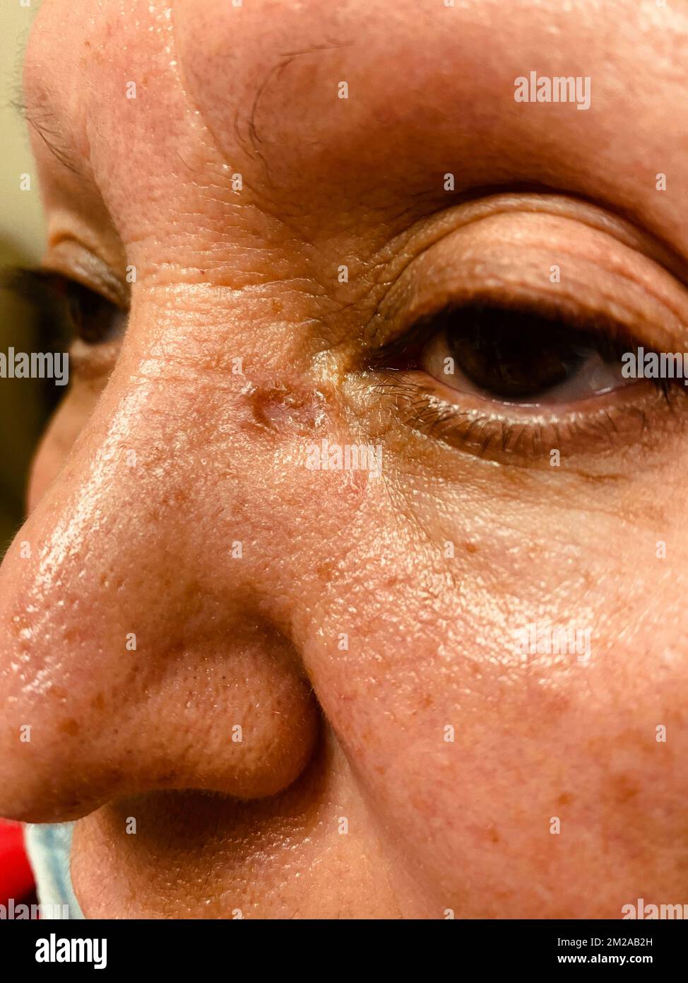 Basal cell carcinoma Stock Photo - Alamy