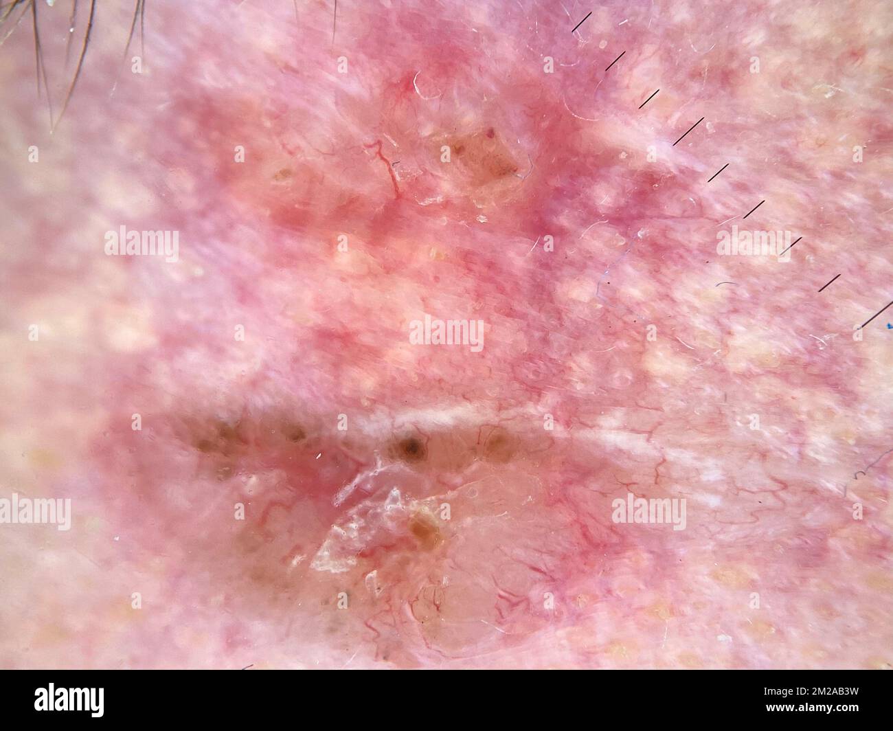 Basal cell carcinoma, dermoscopy Stock Photo - Alamy