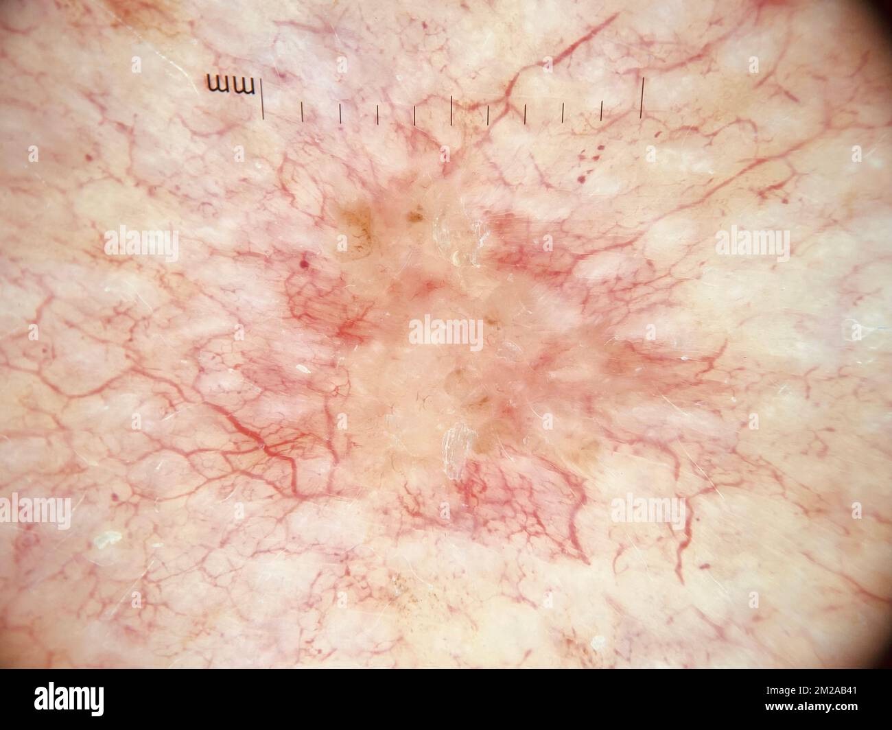 Basal cell carcinoma, dermoscopy Stock Photo - Alamy
